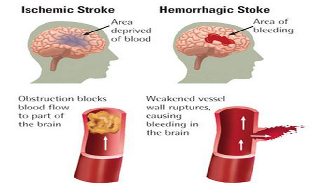 Stroke/ Cerebral apoplexy-Treatments-Beijing Puhua International Hospital